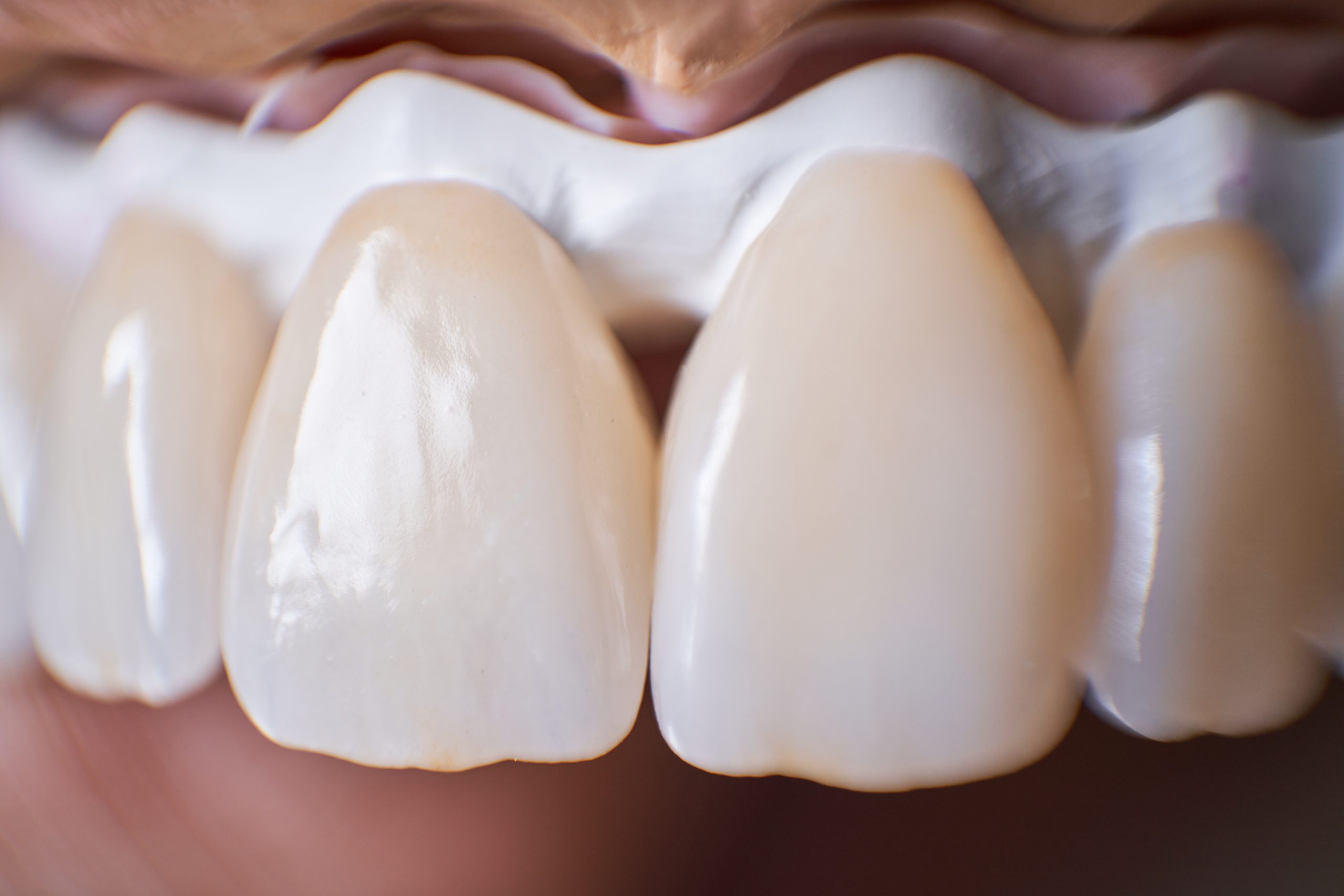Porcelain Laminates - Perfect Teeth Dental NY