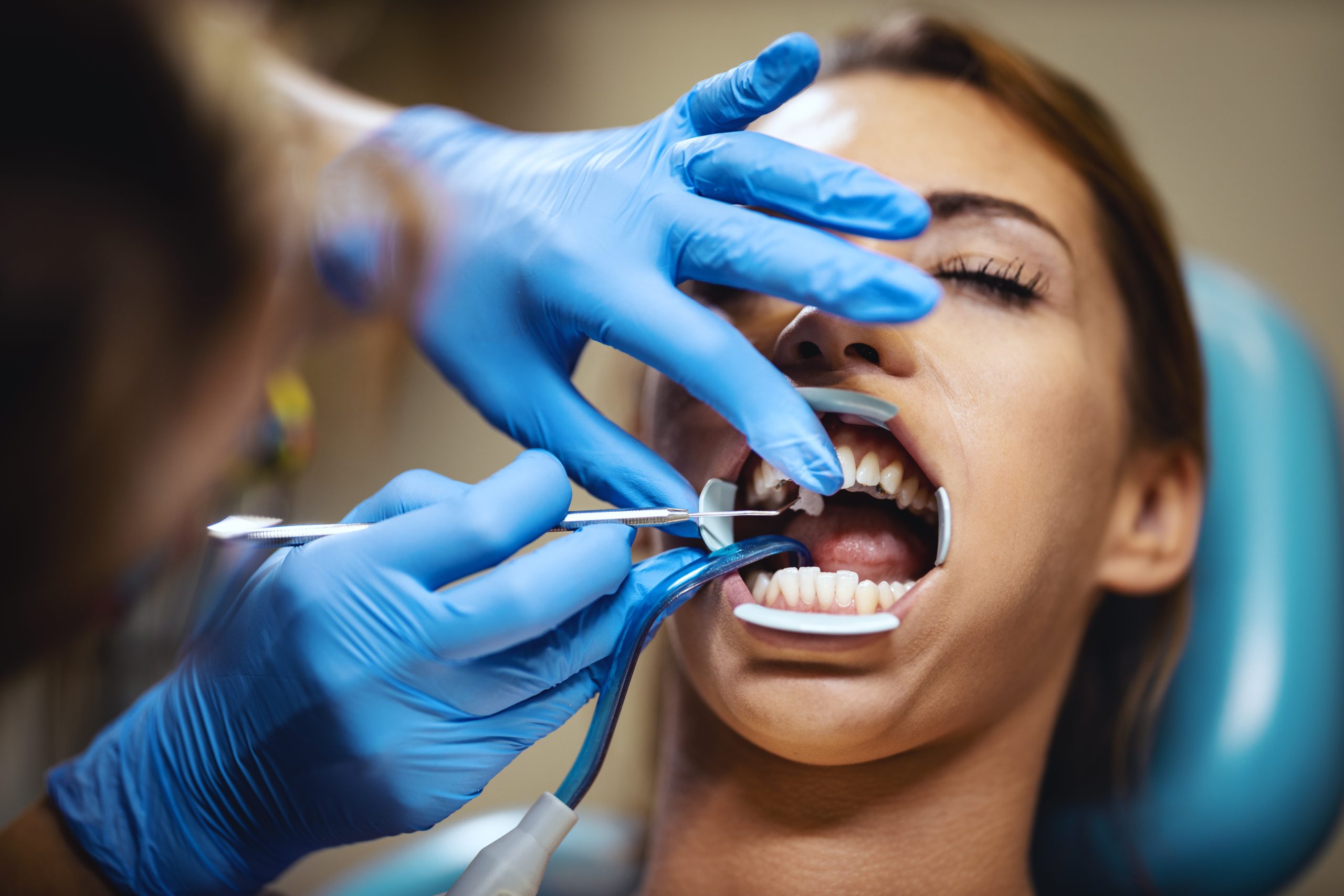 Dental Bonding - Perfect Teeth Dental NY
