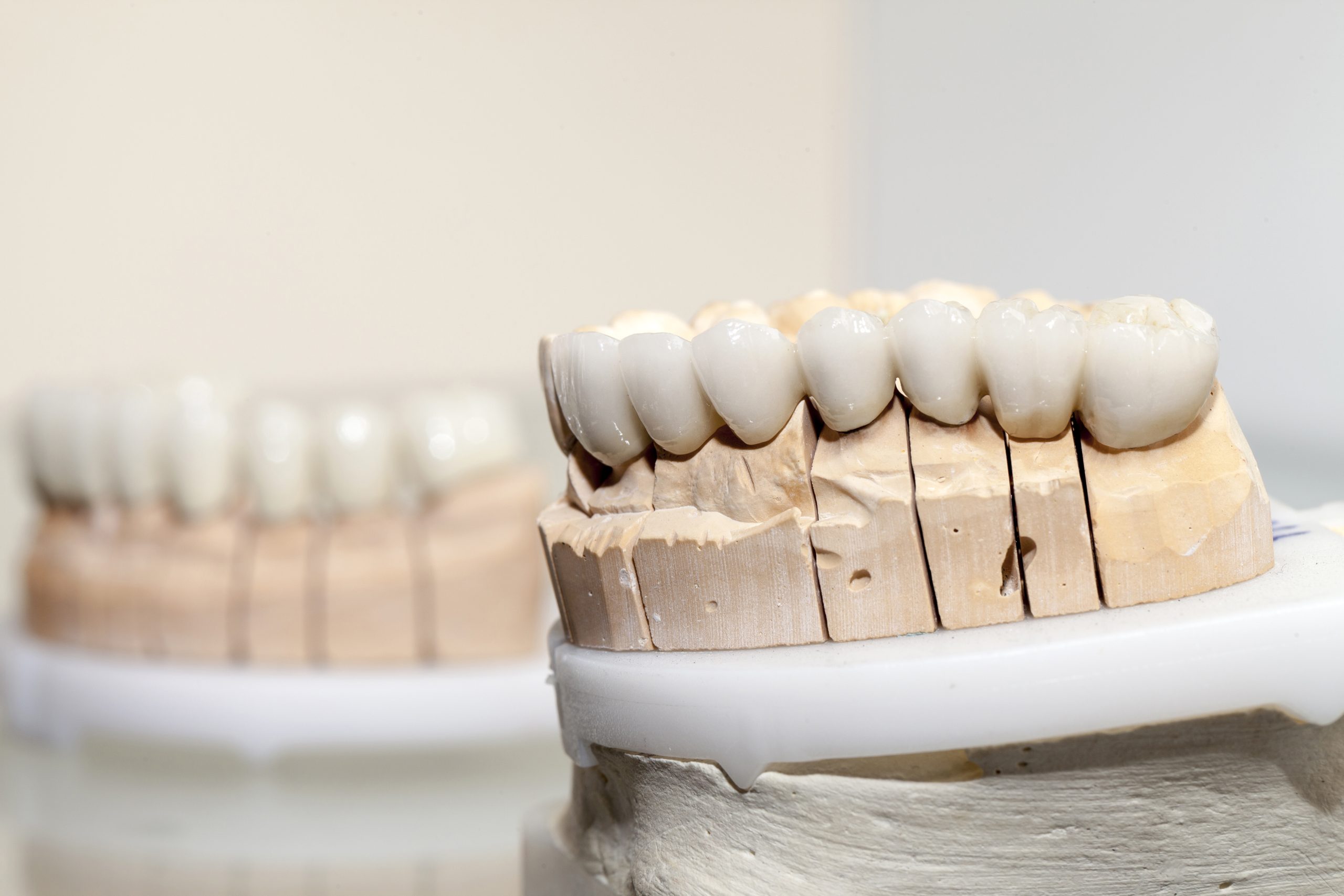 Porcelain Fixed Bridges - Perfect Teeth Dental NY